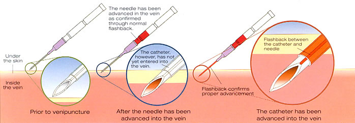 Intravenous Catheter Insertion IV Insertion YouTube